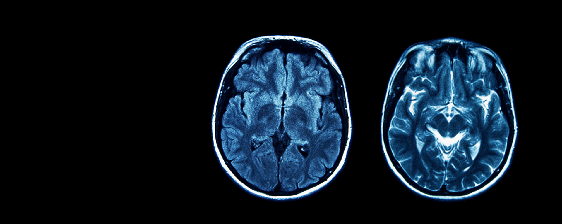 Concussion Brain Compared To Normal